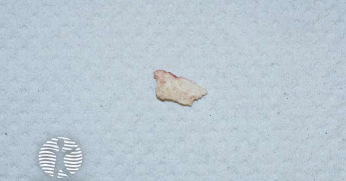 Calcium salt deposit image