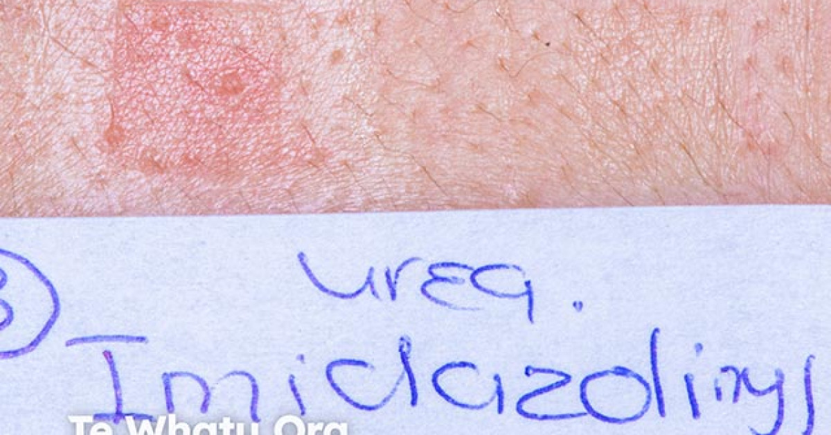 Positive patch test imidazolinyl urea image