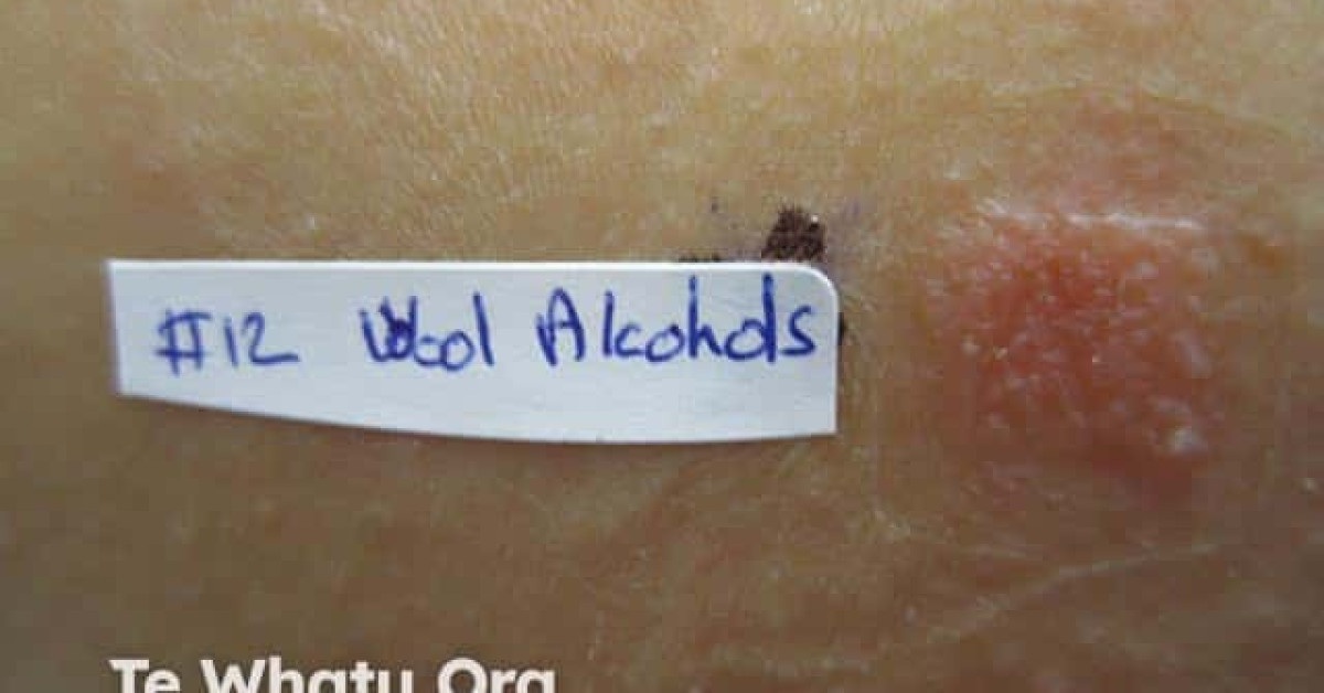 Positive patch test presenting with a red raised plaque on skin where ...