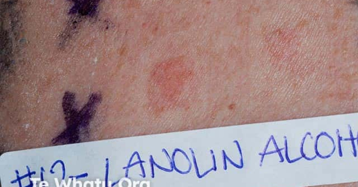 Positive patch test presenting with red macules on skin where lanolin ...