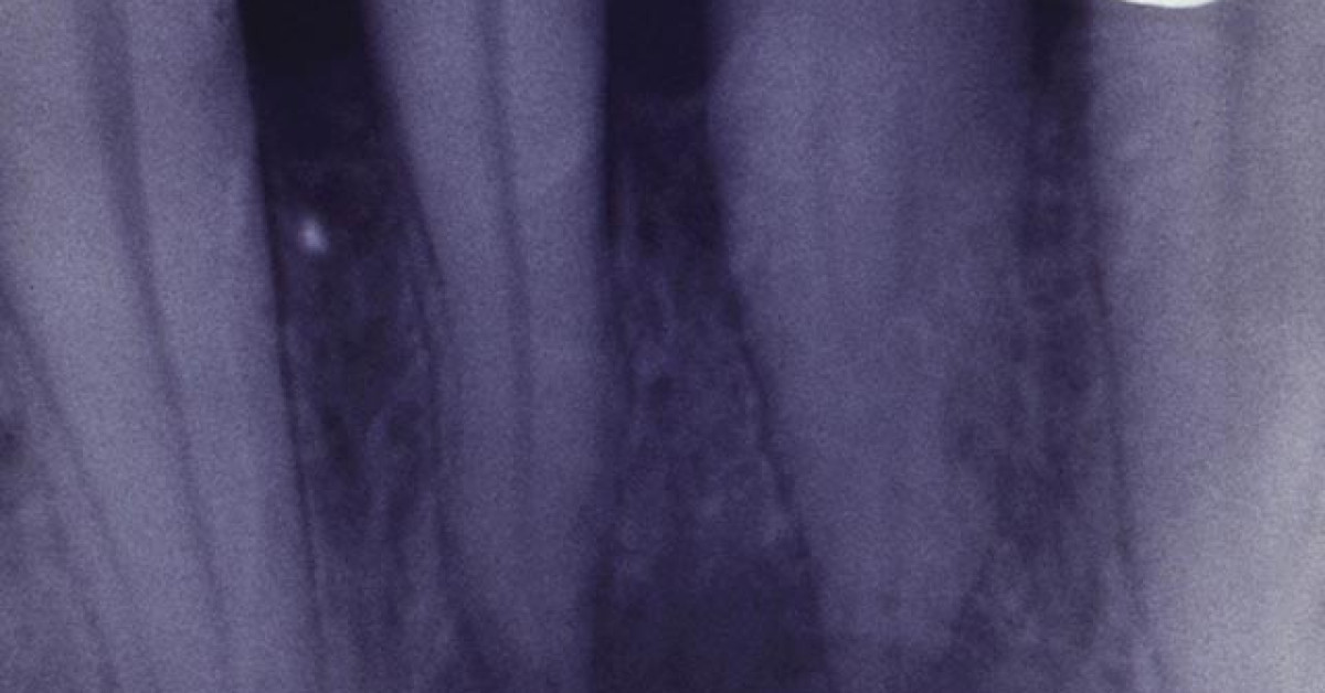 X-ray of dental sinus showing periapical infection image