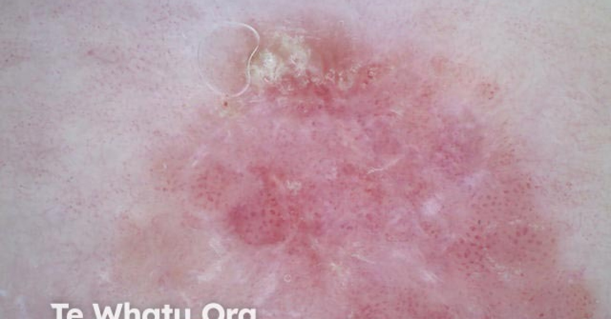 Intraepidermal carcinoma, polarised dermoscopy view image