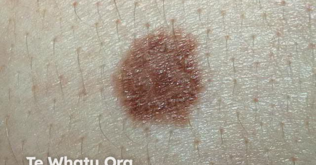 Naevus, skin type 3, macro 1 image