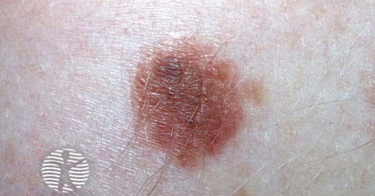 Naevus, skin type 2, macro 3 image