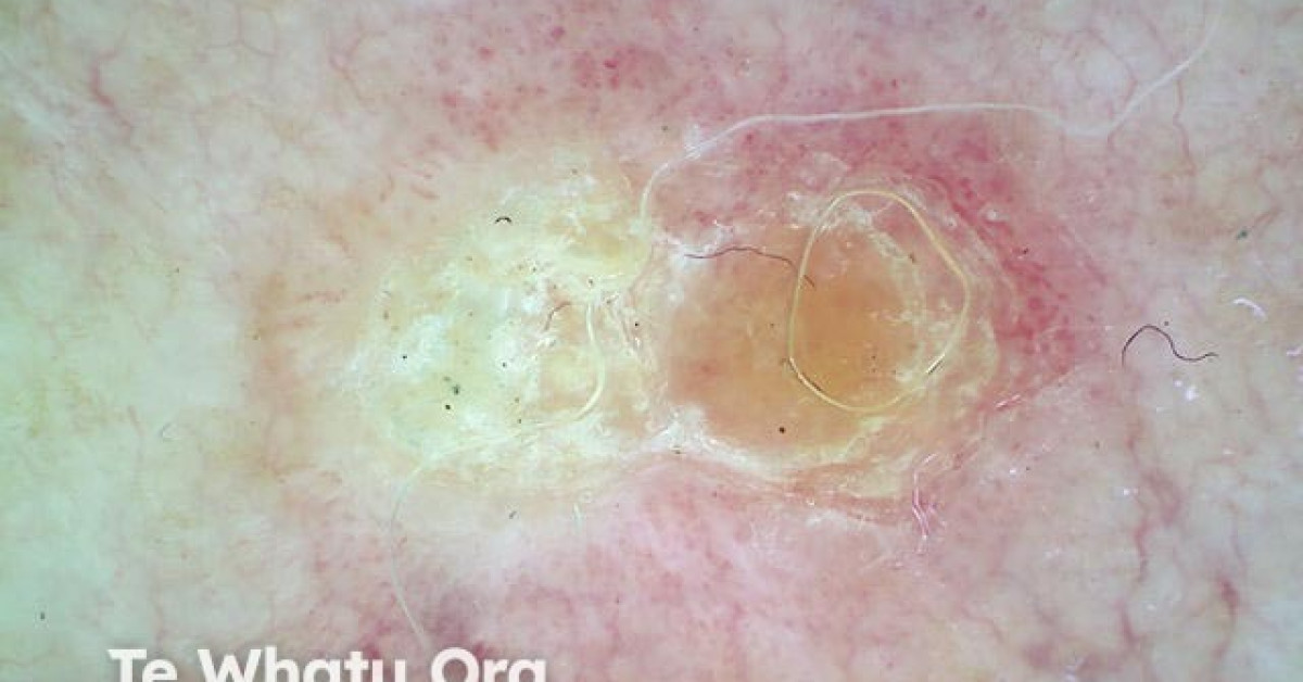 Intraepidermal carcinoma, polarised dermoscopy view image