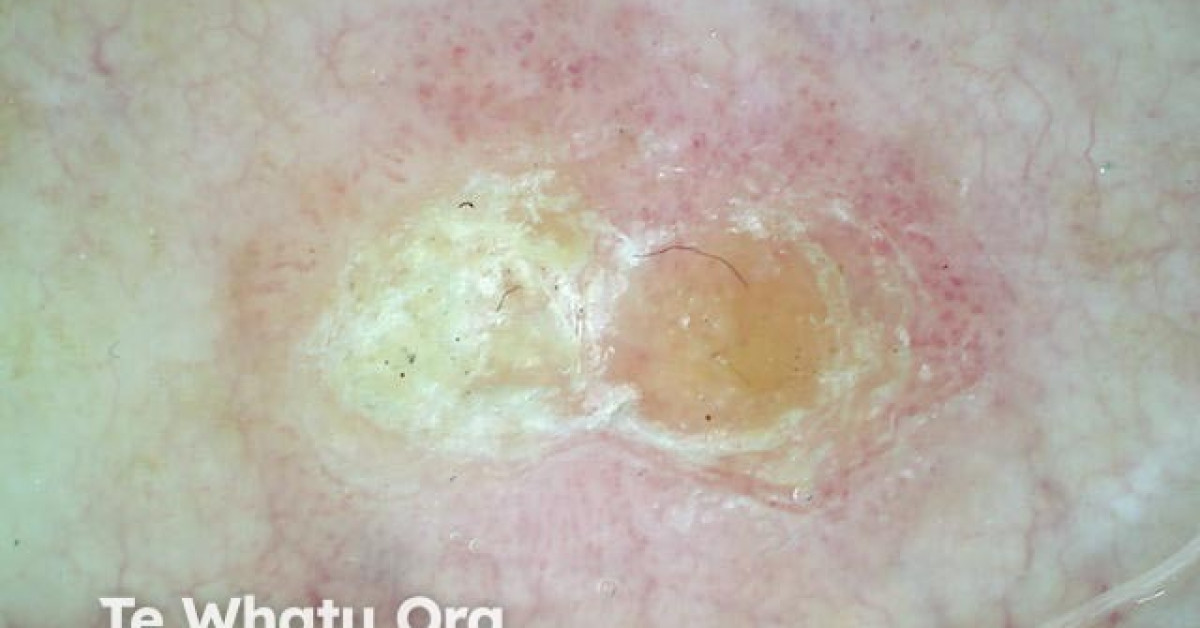Intraepidermal carcinoma, nonpolarised dermoscopy view image