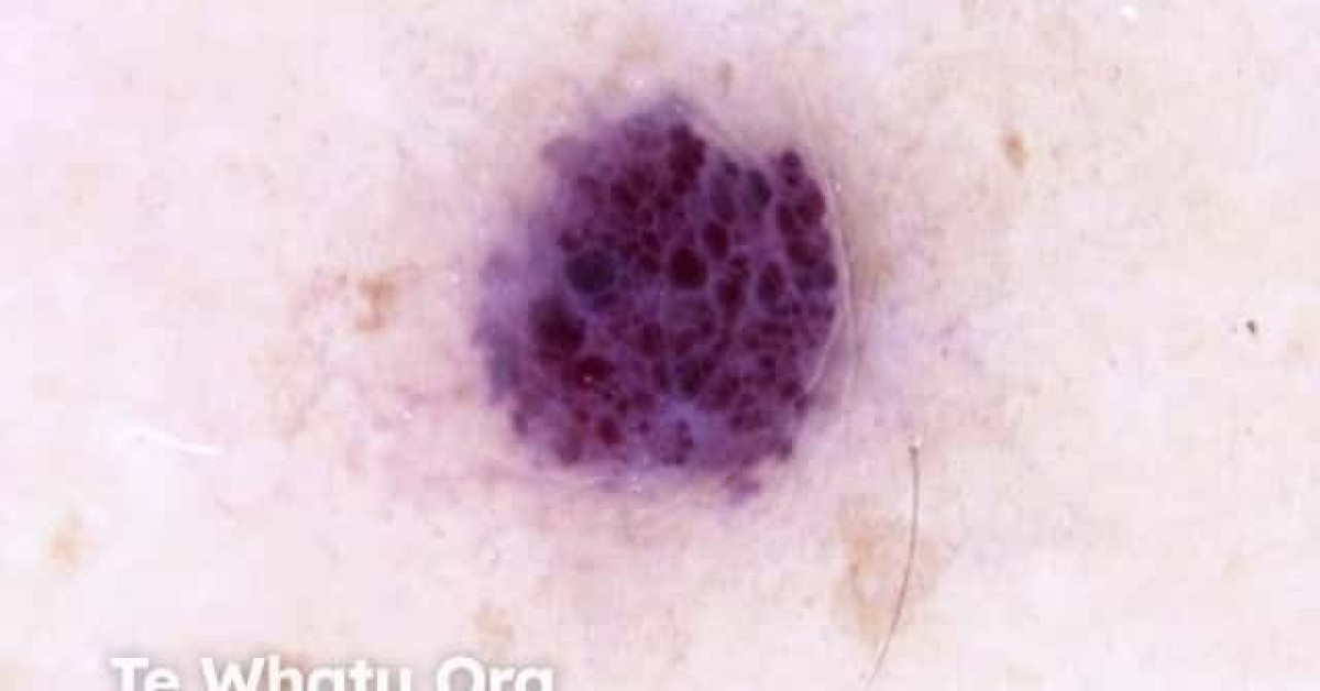 Cherry angioma dermocopy image