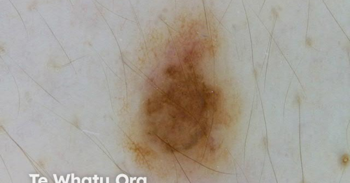 Naevus, skin type 2, dermoscopy 4 image