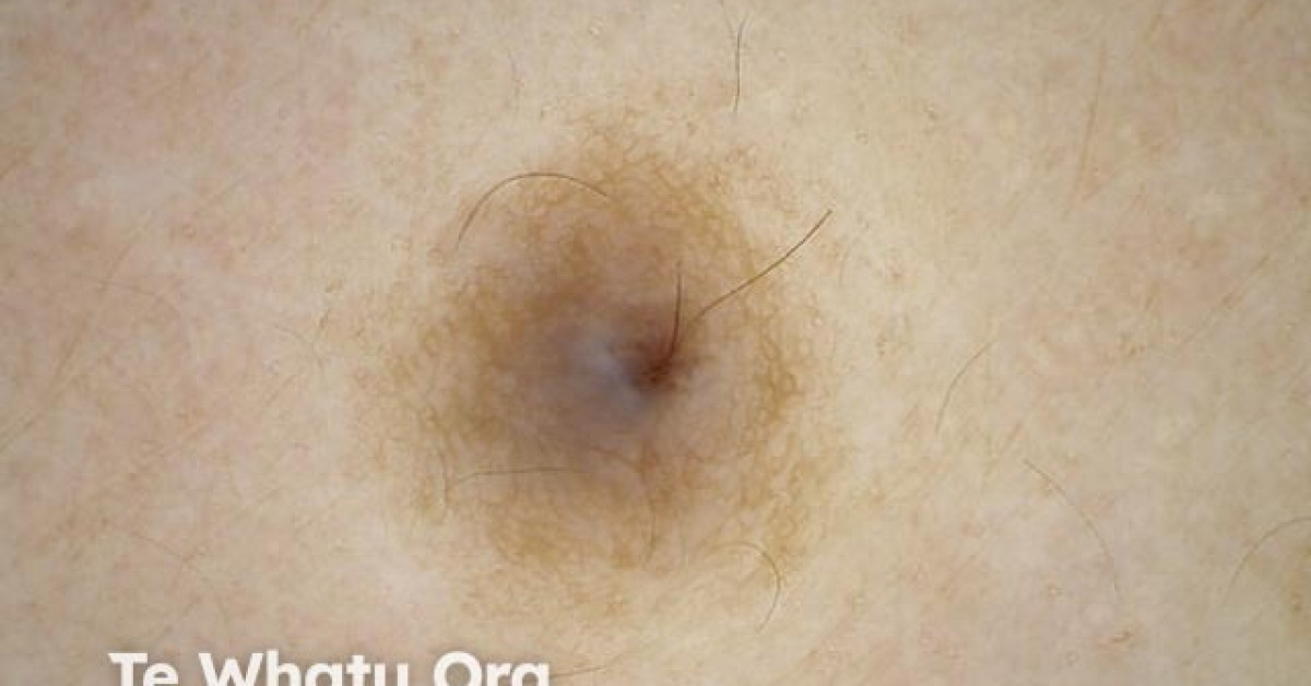 Naevus, skin type 4, dermoscopy 1 image