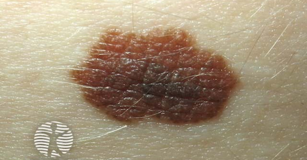 Naevus, skin type 3, macro 4 image