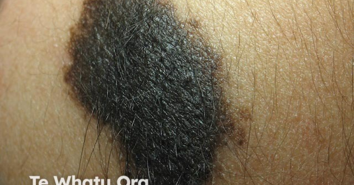 Congenital naevus, skin type 5, macro 1 image