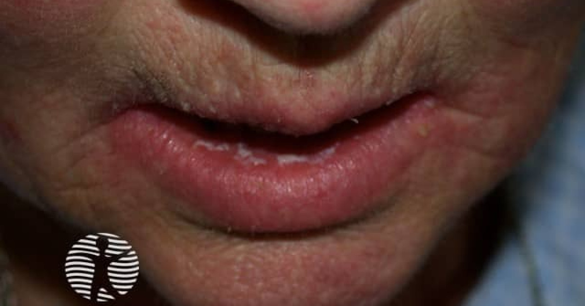 Angular cheilitis image