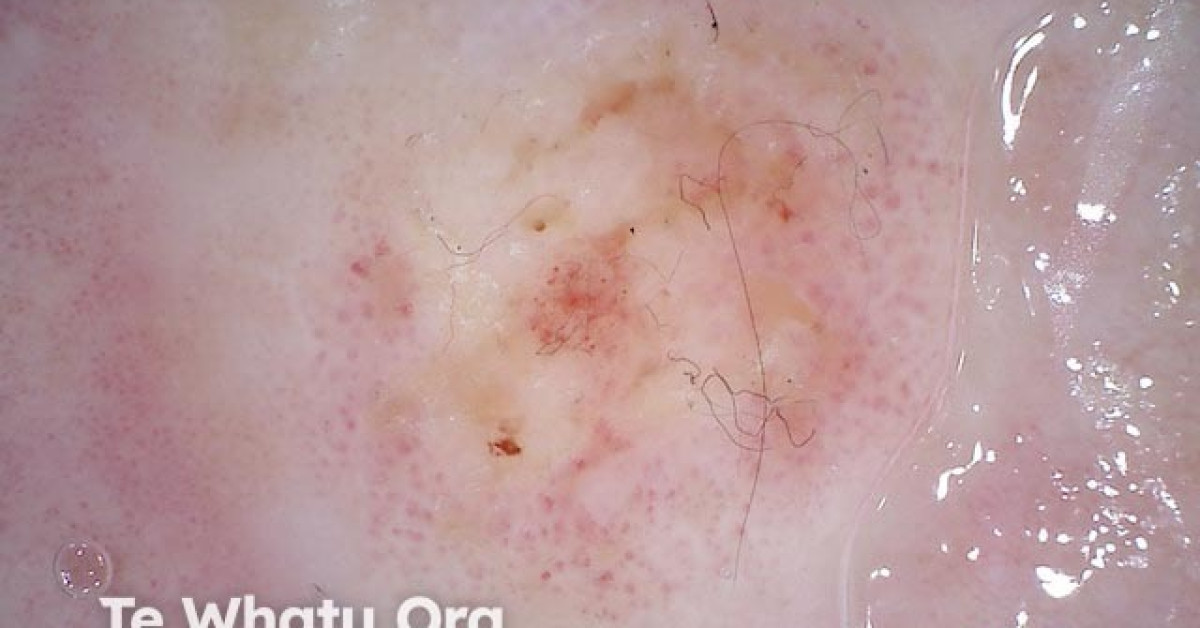 Intraepidermal carcinoma, nonpolarised dermoscopy view image