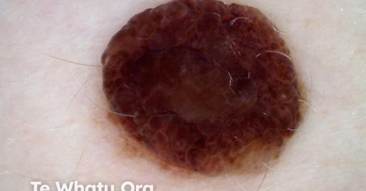 Naevus, skin type 4, dermoscopy 2 image