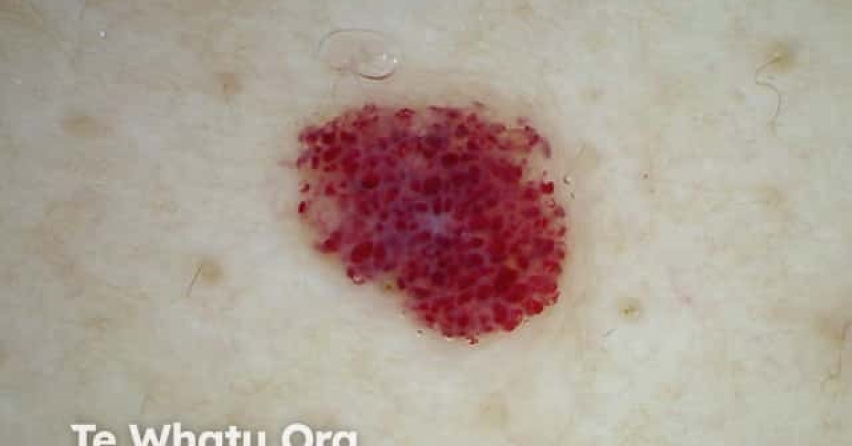 Cherry angioma dermoscopy image