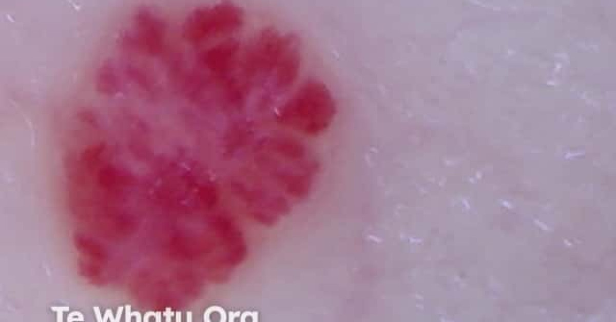 Cherry angioma dermoscopy image