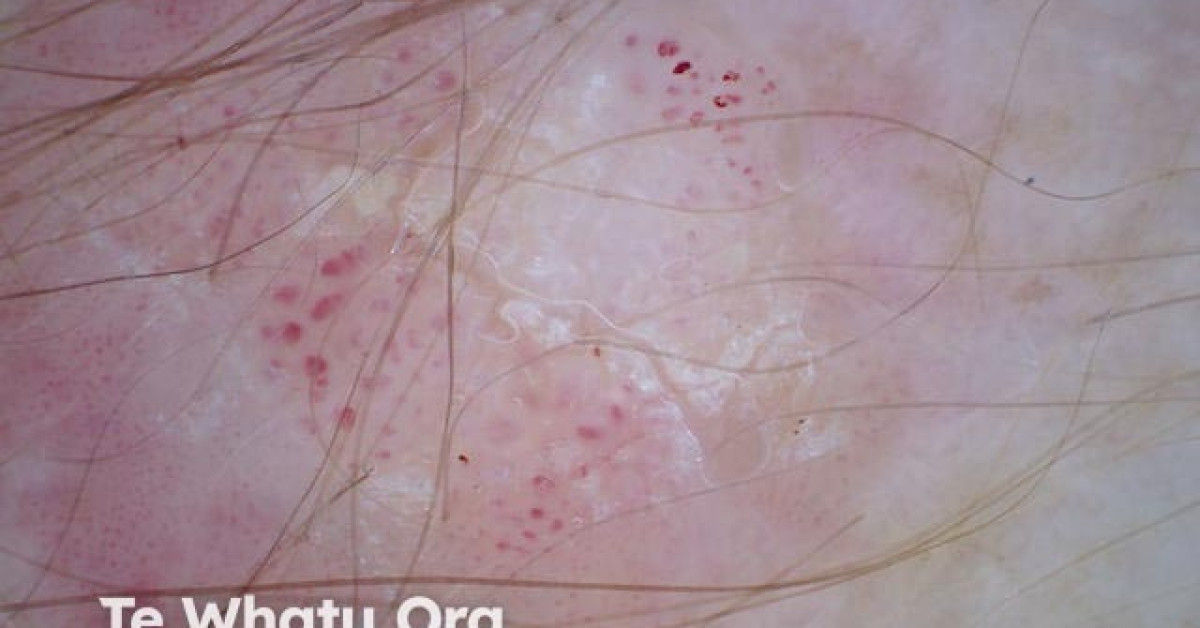 Intraepidermal carcinoma, polarised dermoscopy view image