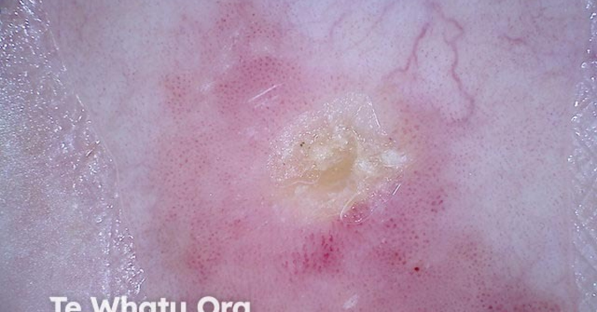 Intraepidermal carcinoma, nonpolarised dermoscopy view image