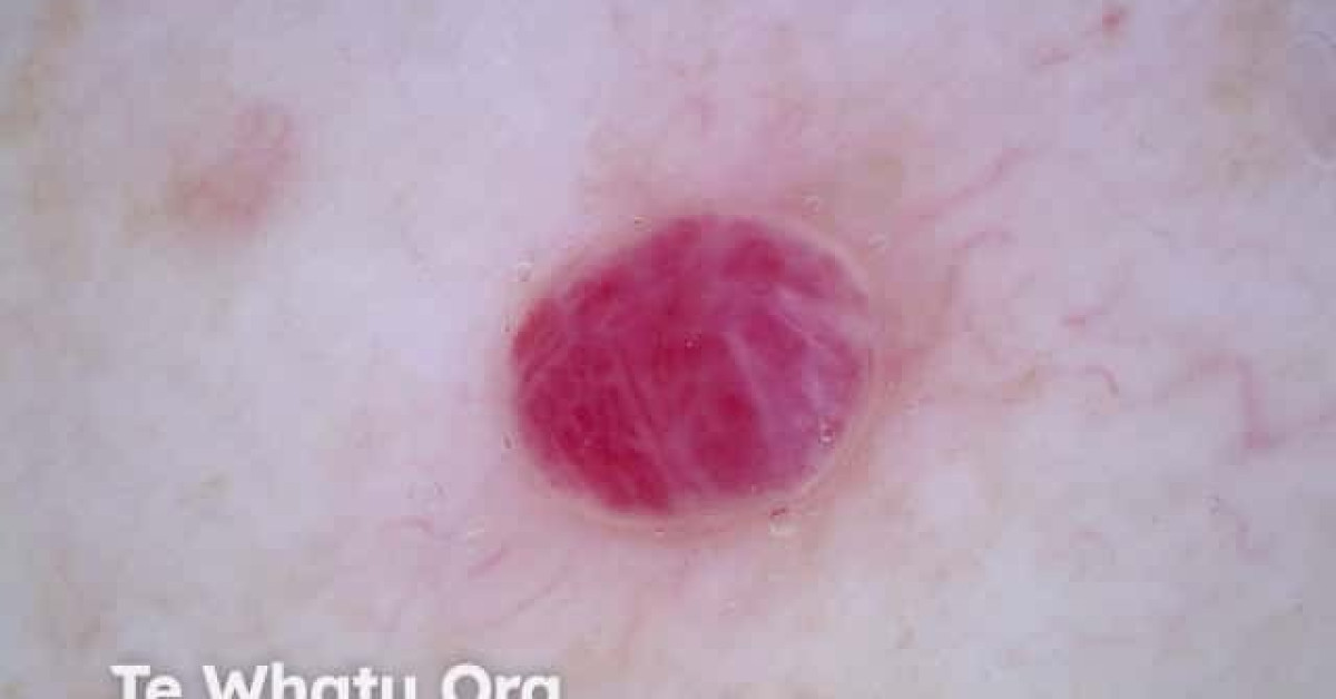 Cherry angioma dermoscopy image
