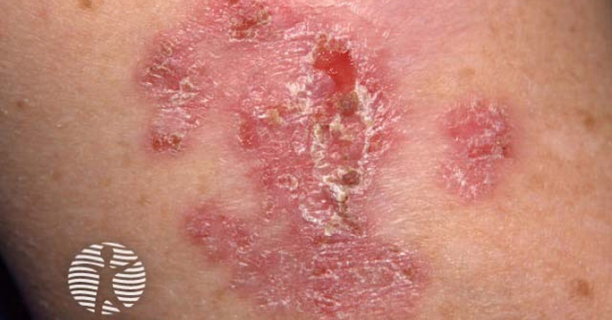 Intraepidermal carcinoma image