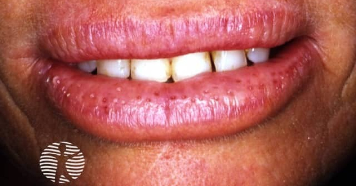 Glandular cheilitis image