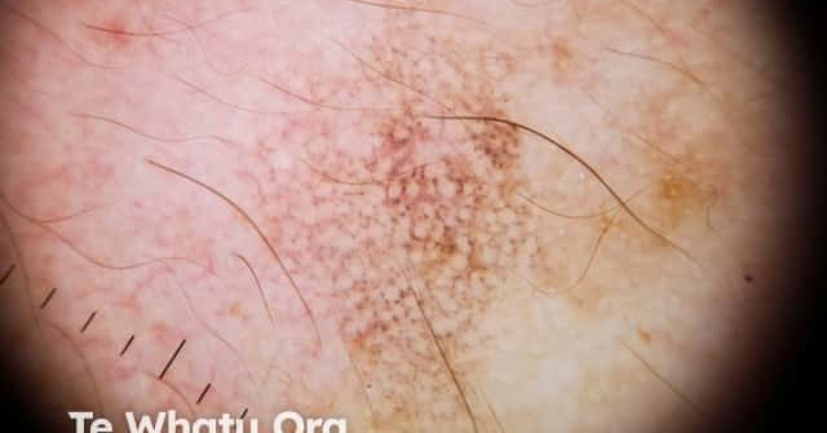 Annular granular pattern seen in dermoscopy of lichen planus-like ...