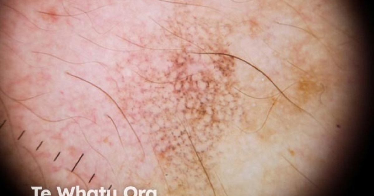 Dermoscopy of lichen planus like keratosis image