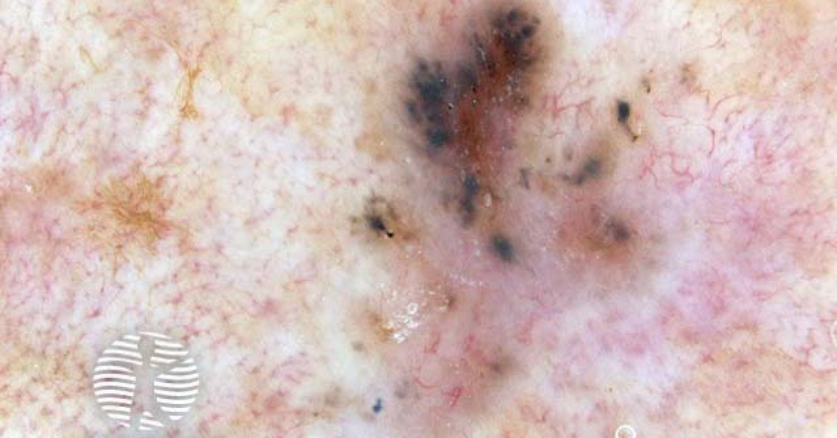 Dermoscopy: pigmented basal cell carcinoma image