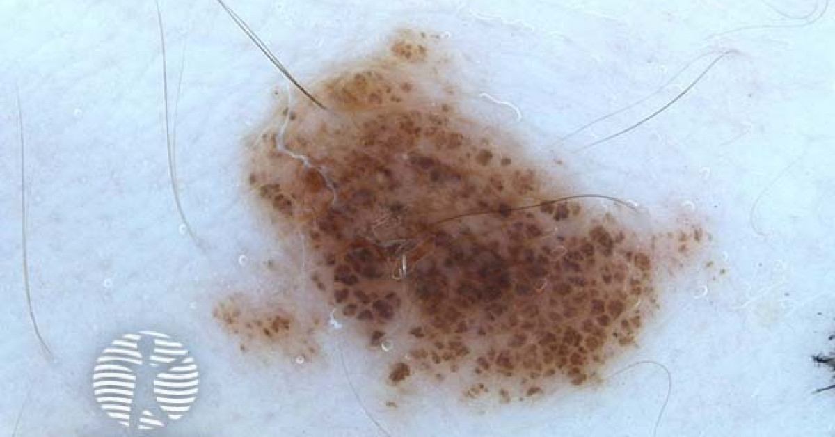 Dermoscopy: globular pattern image