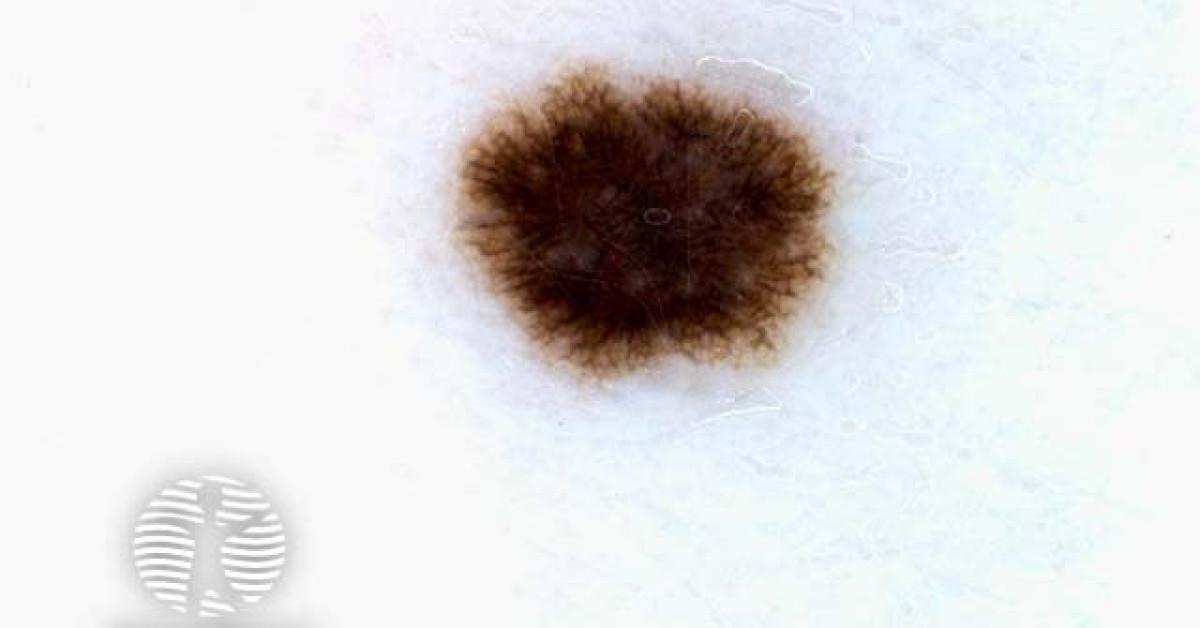 Dermoscopy: radial pattern image