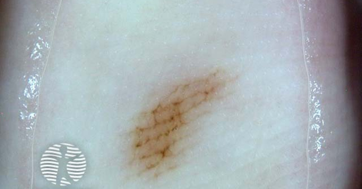 Dermoscopy: parallel pattern image