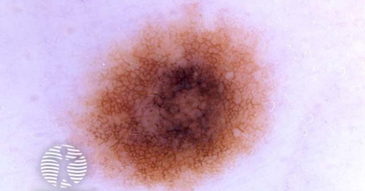 Dermoscopy: reticular globular pattern image