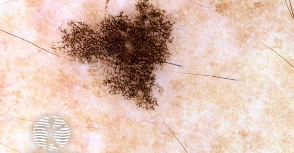 Dermoscopy: ink spot lentigo image