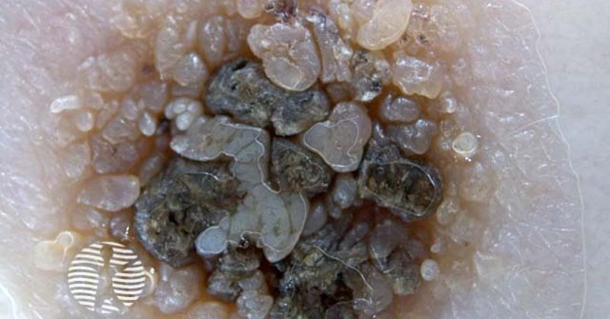 Dermoscopy: seborrhoeic keratosis with exophytic papillary structures image