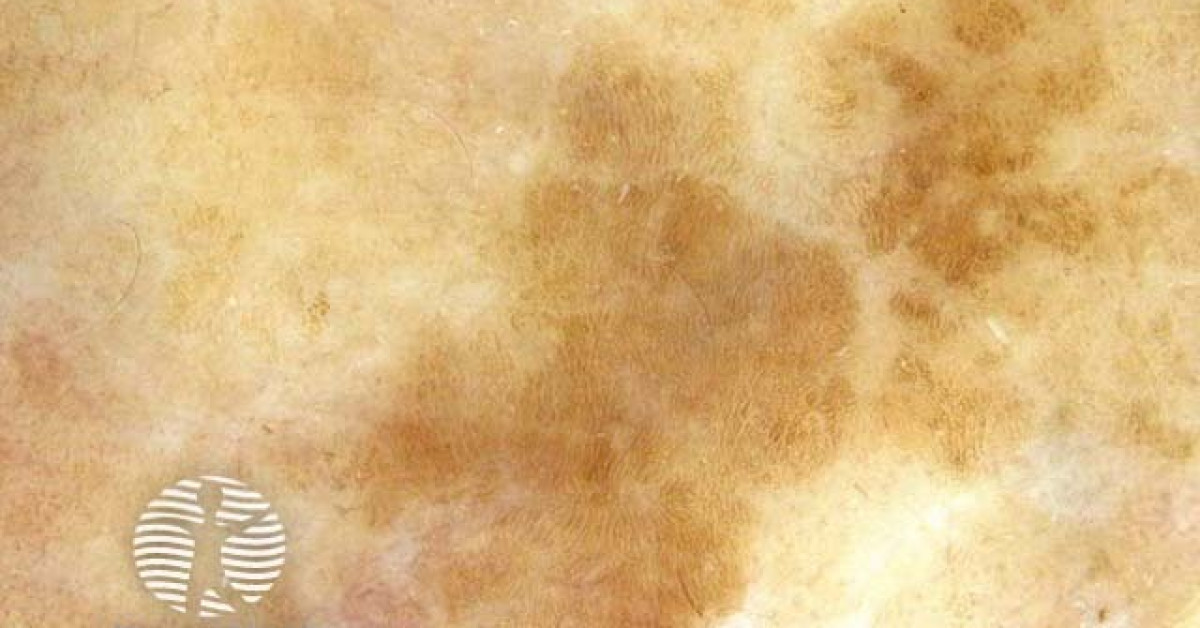 Dermoscopy: solar lentigo with fingerprint-like structures image