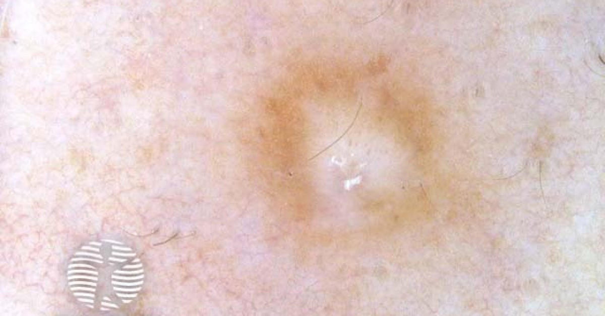 Dermoscopy: dermatofibroma image