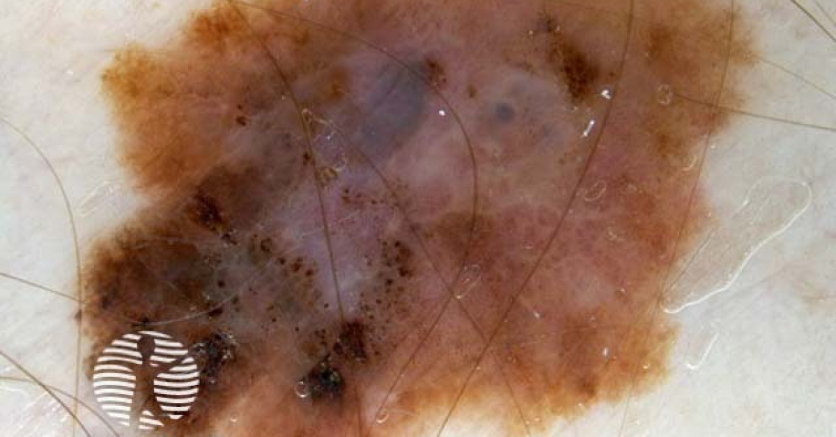 Dermoscopy: melanoma with streaks image