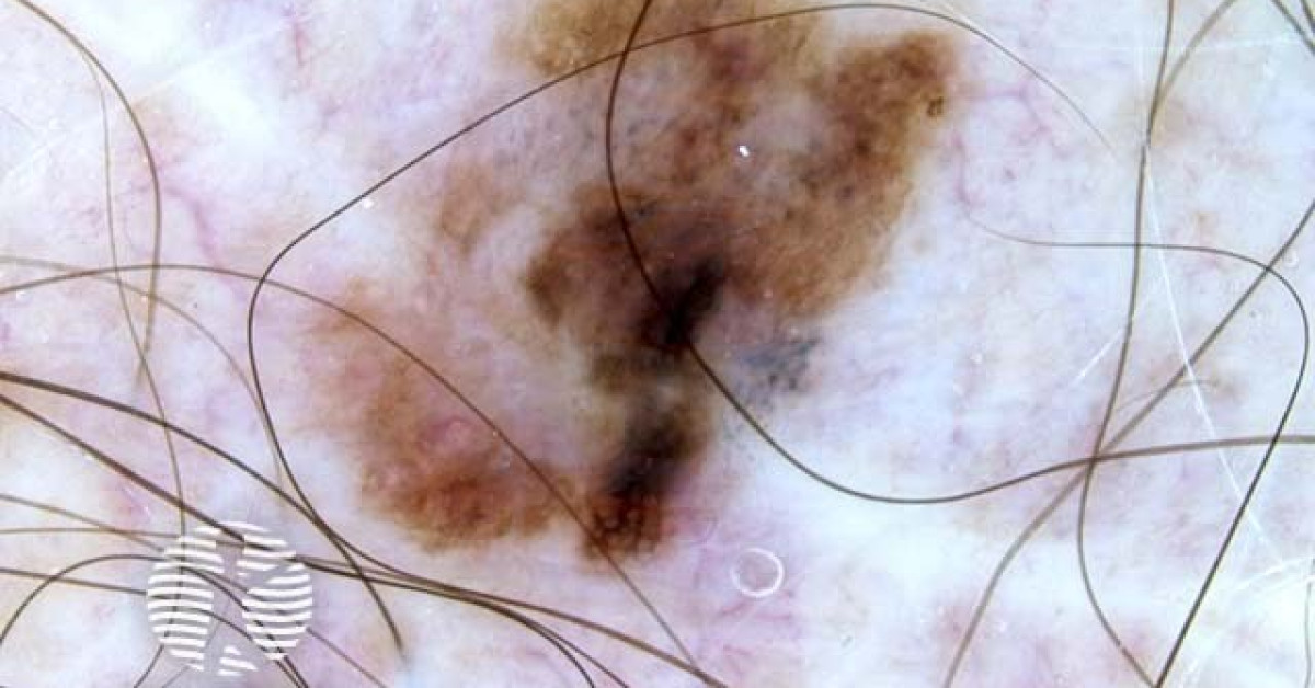 Dermoscopy: melanoma with regression structures image