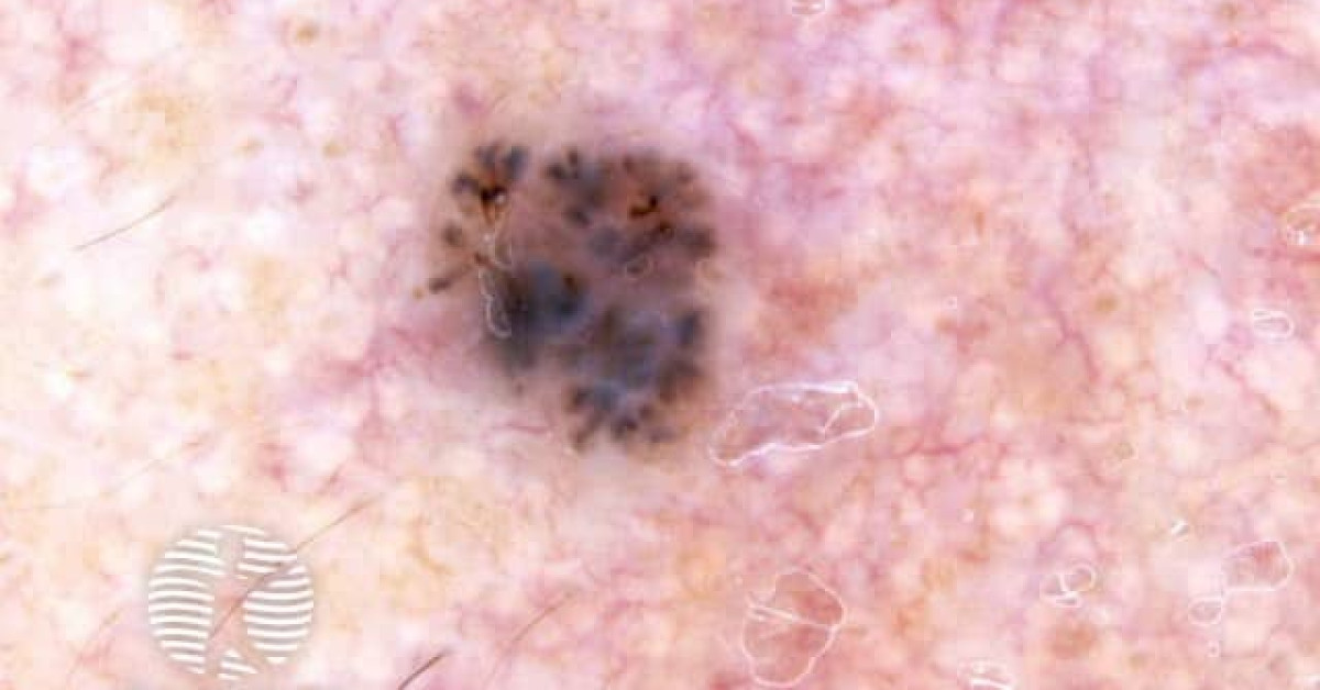 Leaf like areas in pigmented basal cell carcinoma dermoscopy image