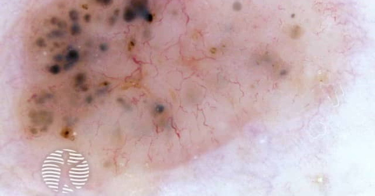 Branching serpentine vessels and blue-grey ovoid nests in pigmented ...