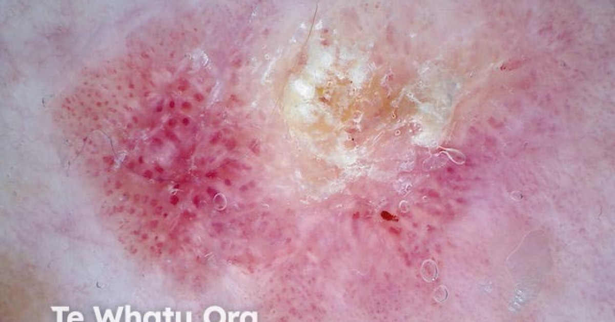 Intraepidermal carcinoma, polarised dermoscopy view image