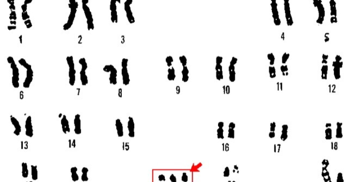 21 trisomy Down syndrome image