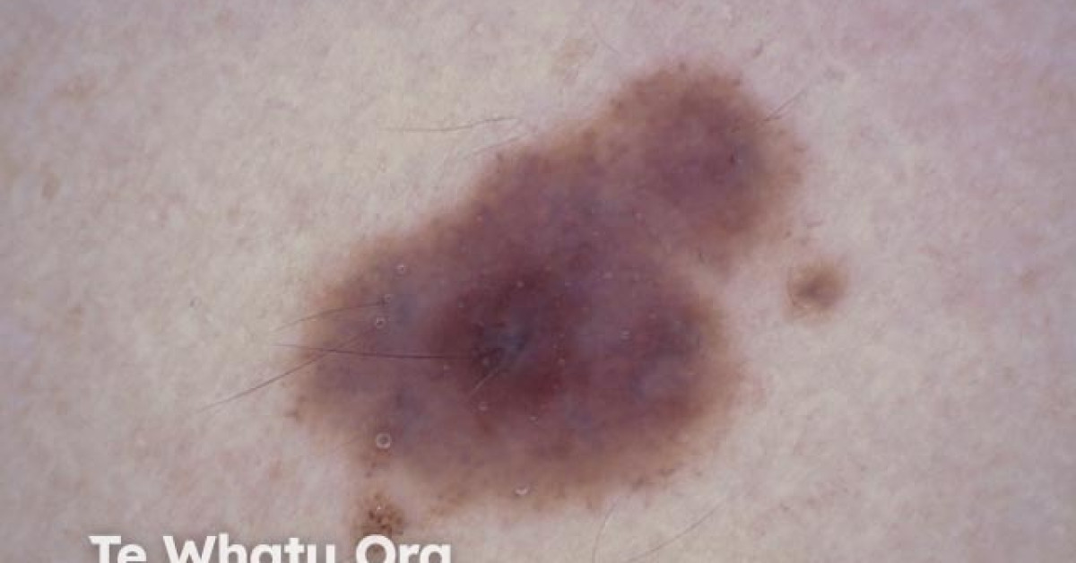 Naevus, skin type 4 dermoscopy 4 image