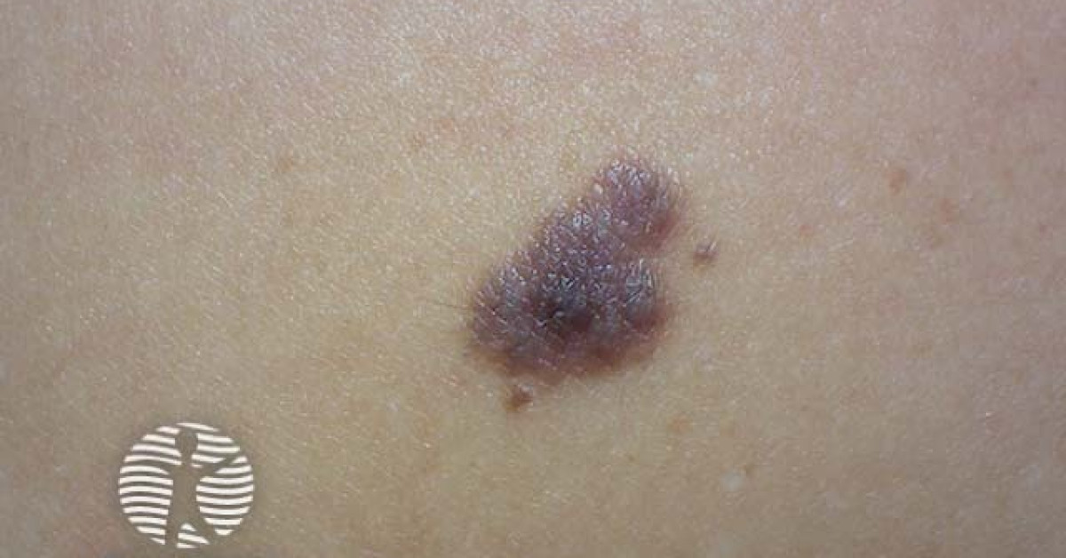 Naevus, skin type 4, macro 4 image