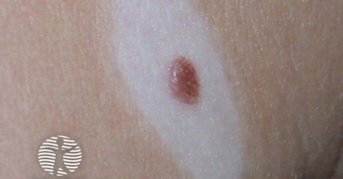 Halo mole image