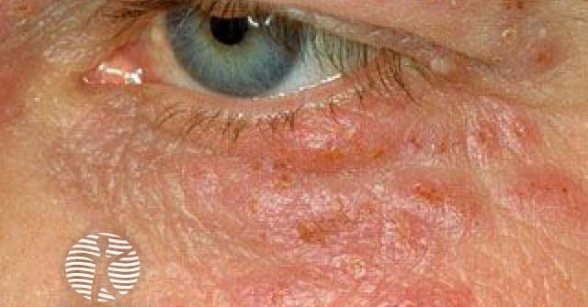 Herpes simplex image