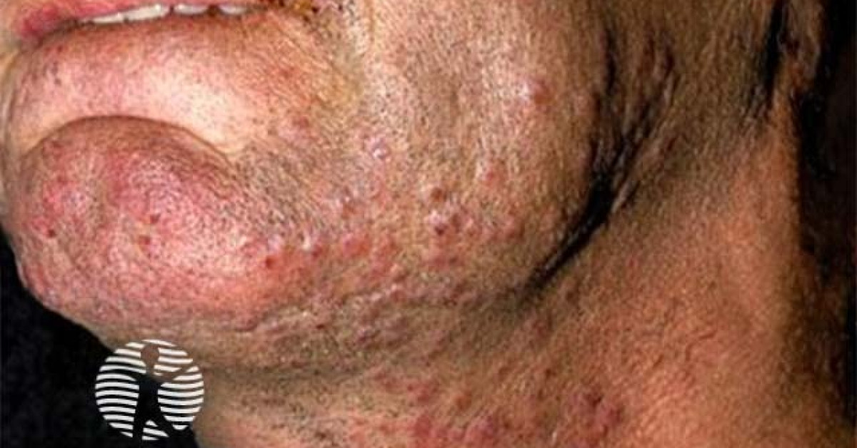 Herpes simplex image