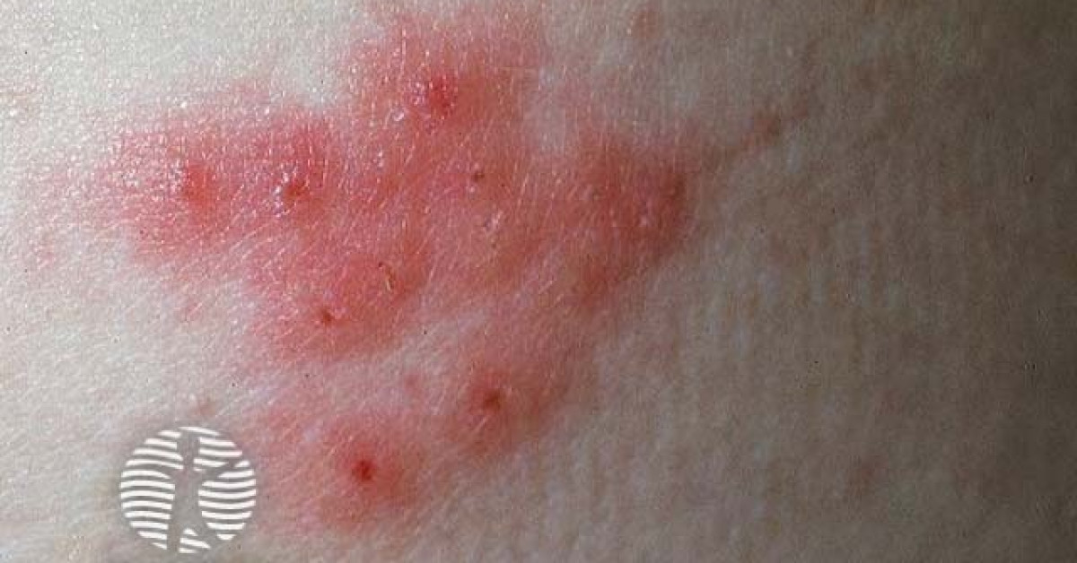 Herpes simplex image