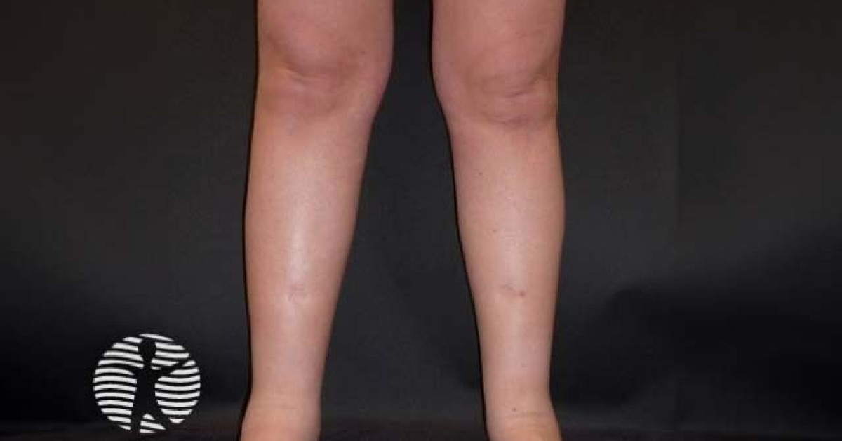Primary lymphoedema image