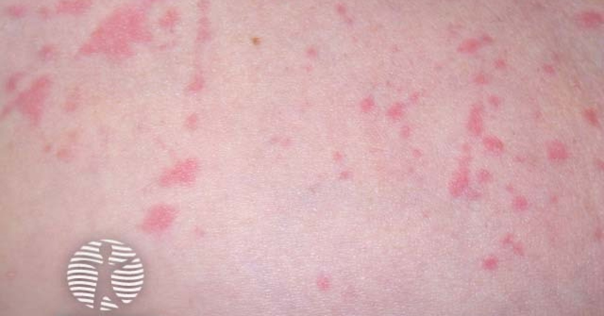 Urticarial vasculitis image